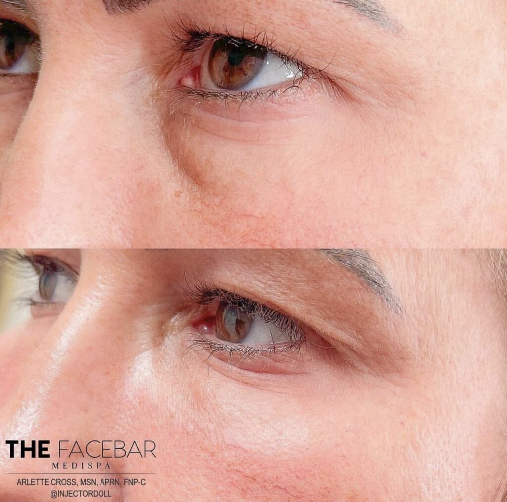 Results - The Face Bar Aesthetic Medical DBA