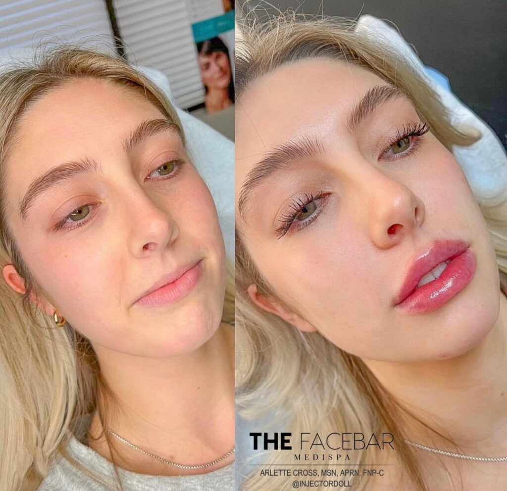 Results - The Face Bar Aesthetic Medical DBA