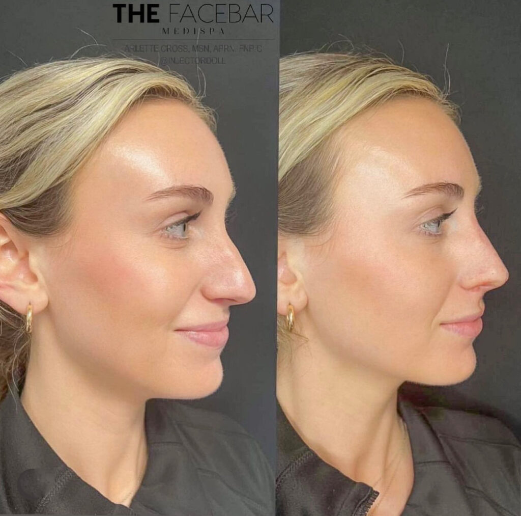 Results - The Face Bar Aesthetic Medical DBA