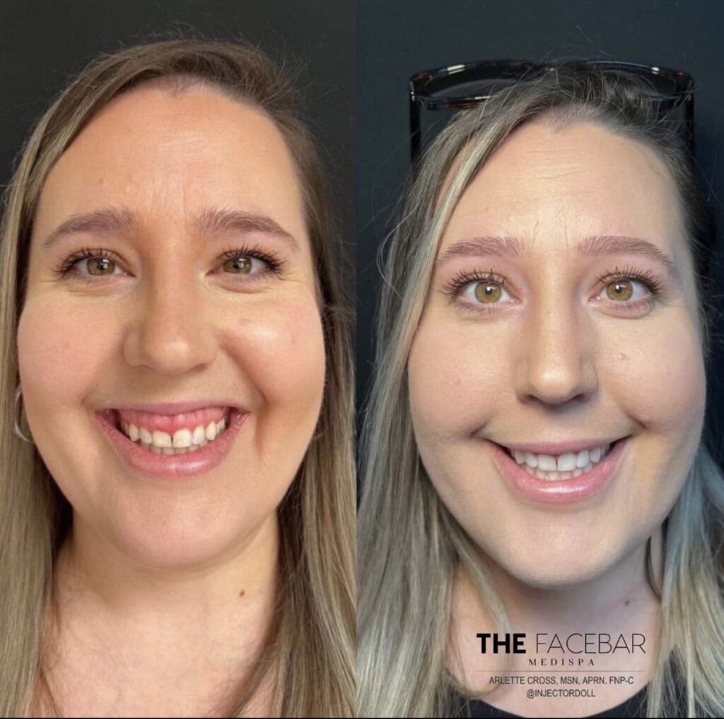 Results - The Face Bar Aesthetic Medical DBA