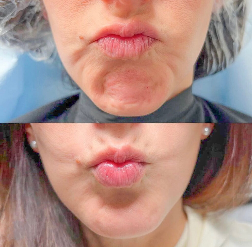 Results - The Face Bar Aesthetic Medical DBA