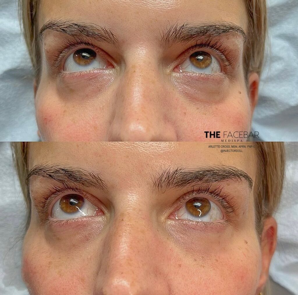 Results - The Face Bar Aesthetic Medical DBA